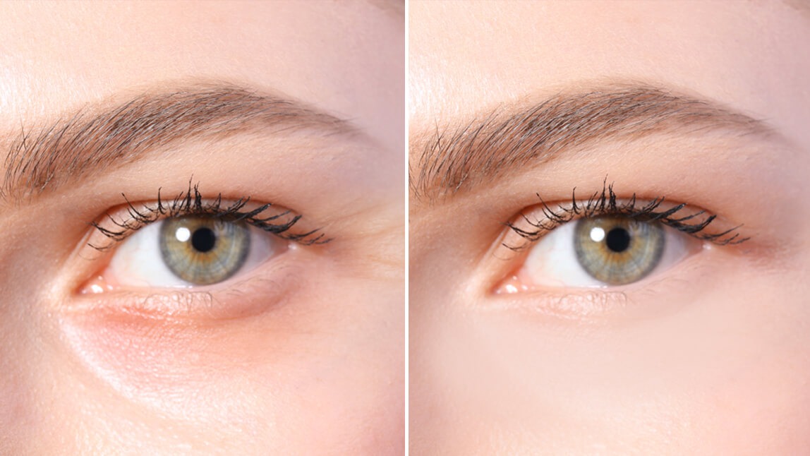 How To Get Rid Of Under Eye Wrinkles Free Treatment Tips PERFECT